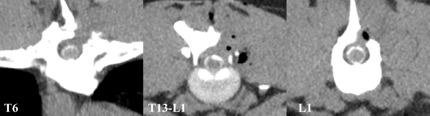 Continuous hemilaminectomy of nine vertebrae can be performed safely in ...