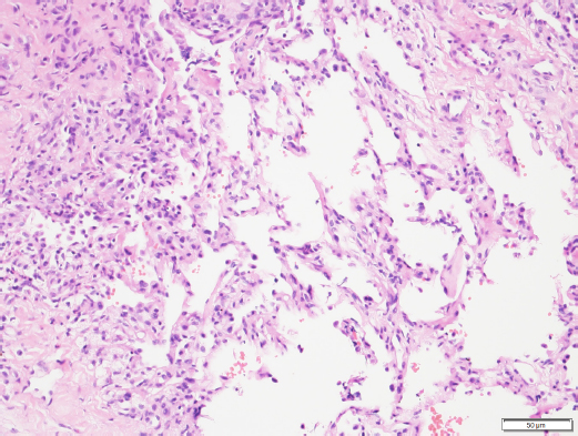 Eosinophilic pulmonary granulomatosis resembling a pulmonary carcinoma ...